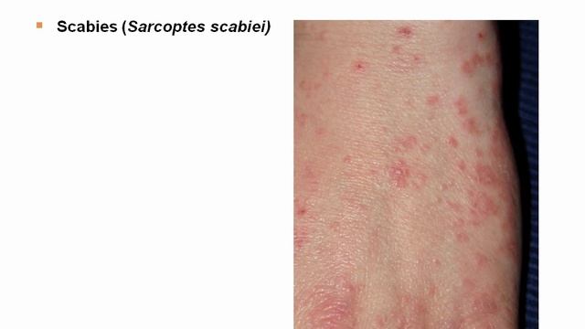 USMLE RX - 7.Микробиология - 5.Паразитология - 8.Эктопаразиты