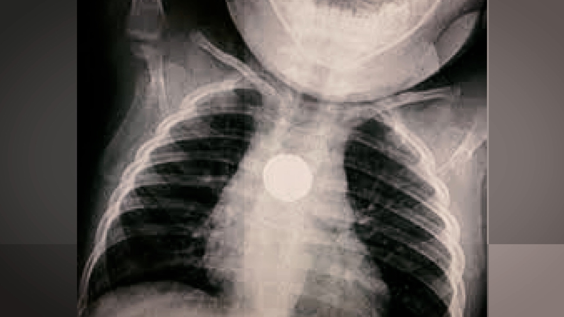 Инородное тело в желудке | История болезни 26.05.2022