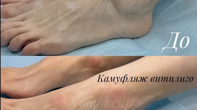 УБРАЛИ ВИТИЛИГО-ЗАКРАСИЛИ ПЯТНА НА ДОЛГИЕ ГОДЫ.