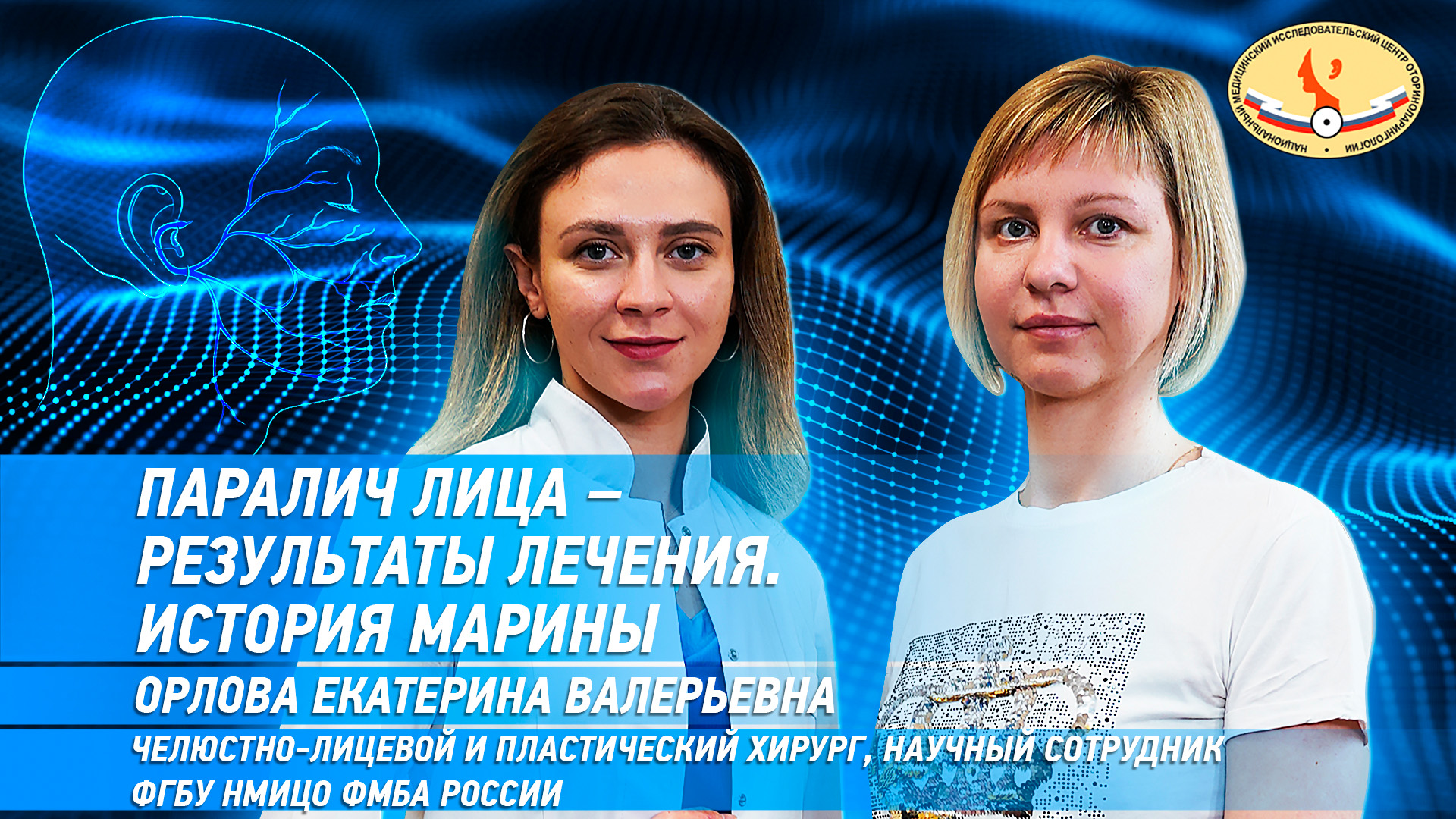 Паралич лица,  результаты лечения. История Марины.
