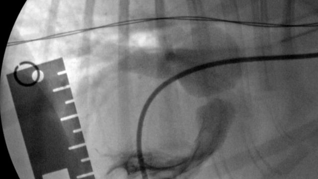 Аускультация собаки  Систолический шум при стенозе клапана легочной артерии. Слушать в наушниках.
