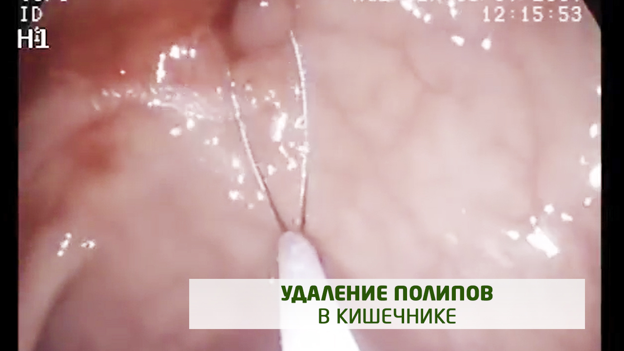 Удаление полипов кишечника под наркозом