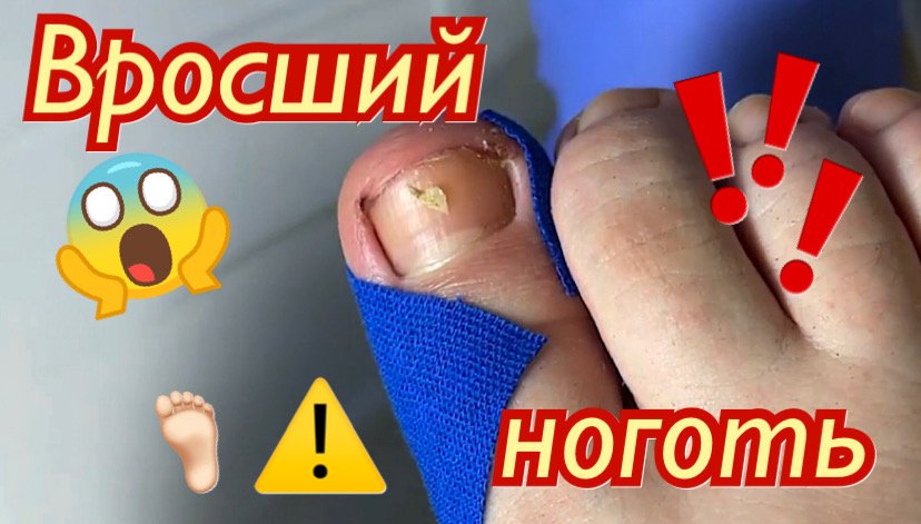 Вросший ноготь ?⚠️❗️???