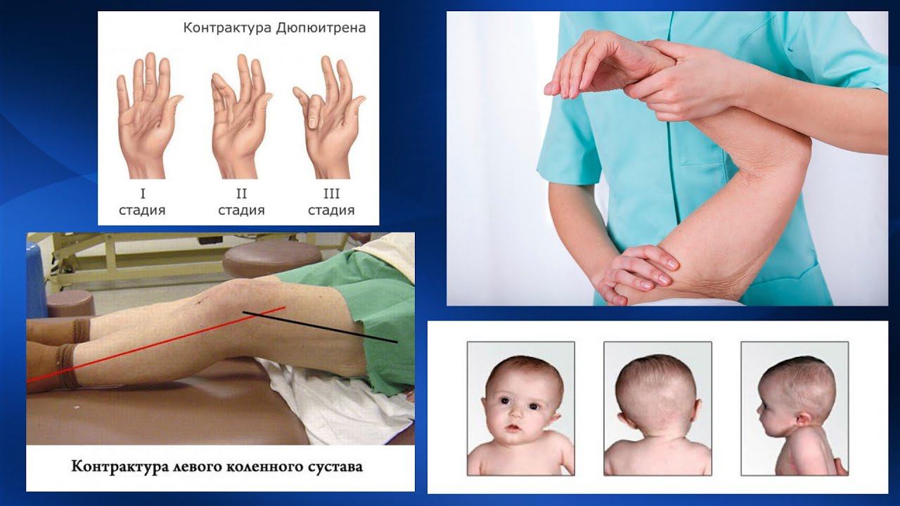 2.05. Массаж при контрактурах | Медицинский массаж. Цикл 2