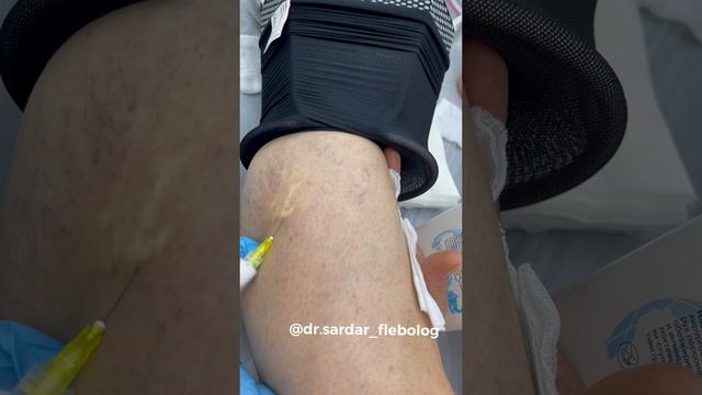 Процедура склеротерапии. Удаление сосудистой сетки на ногах. Лечение варикоза. Флеболог Москва