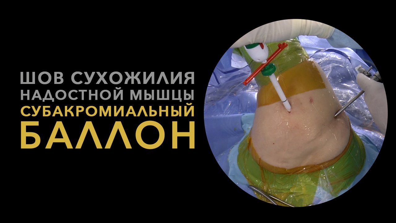 Шов сухожилия надостной мышцы, тенодез сухожилия бицепса и установка субакромиального баллона