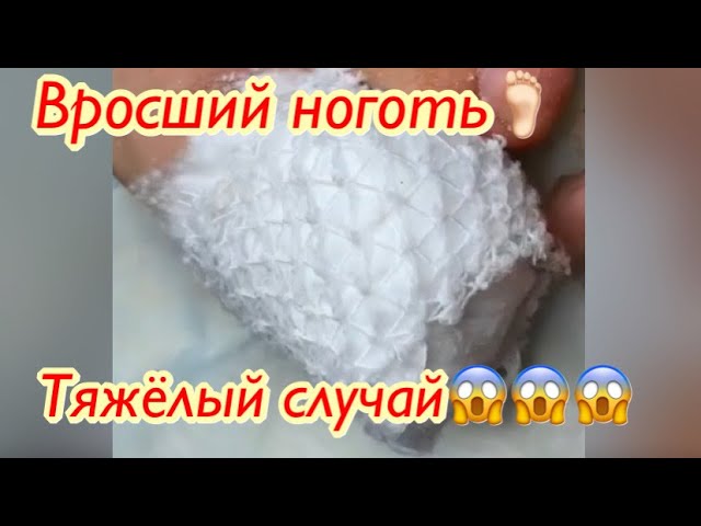 Вросший ноготь??• Тяжёлый случай???