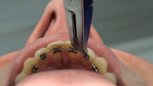 2D — снятие брекетов, Dr. Alexander Gebhardt