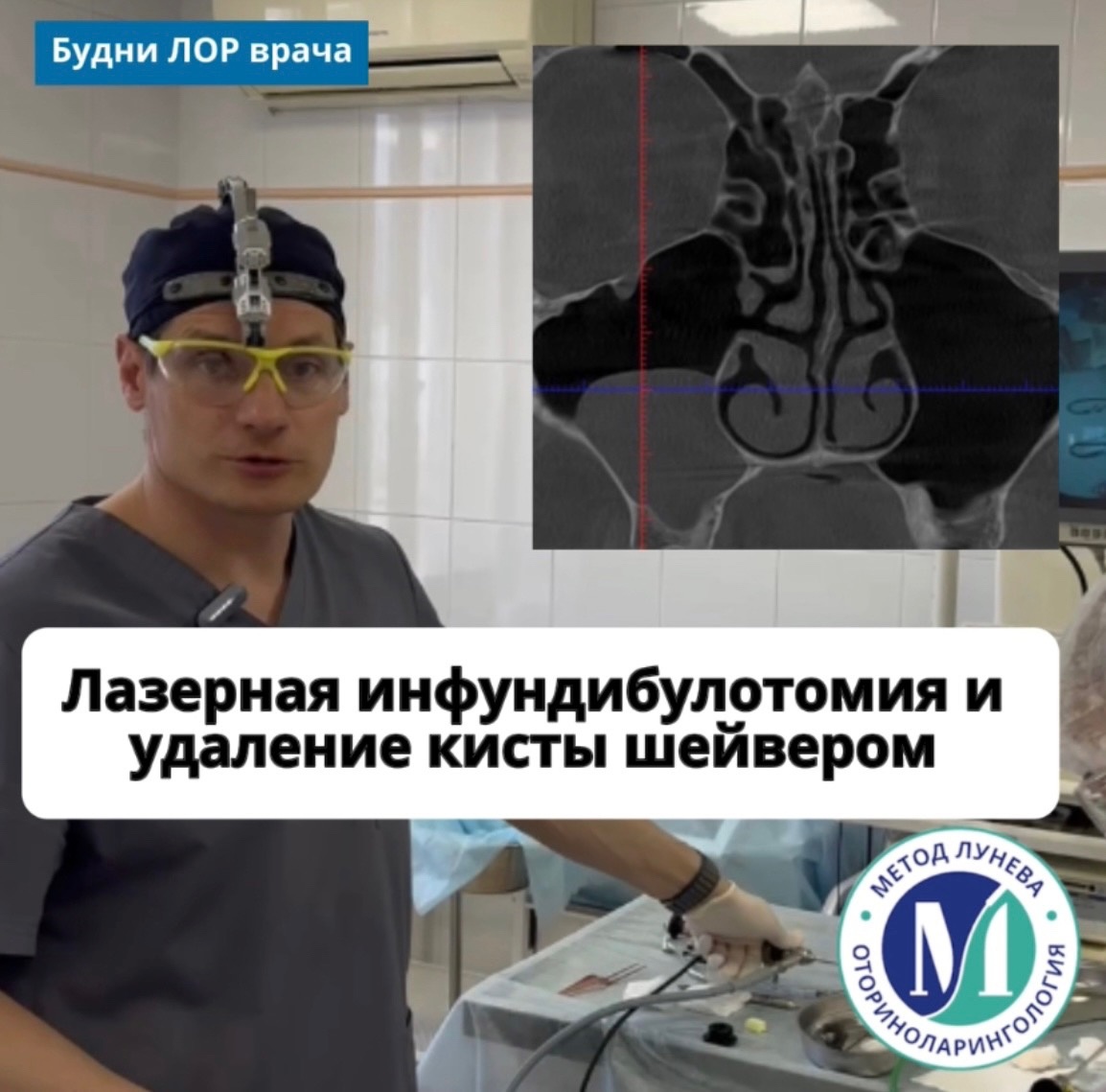 Лазерная инфундибулотомия и удаление
кисты верхнечелюстной пазухи шейвером.