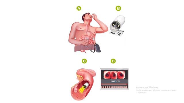 Капсульная эндоскопия