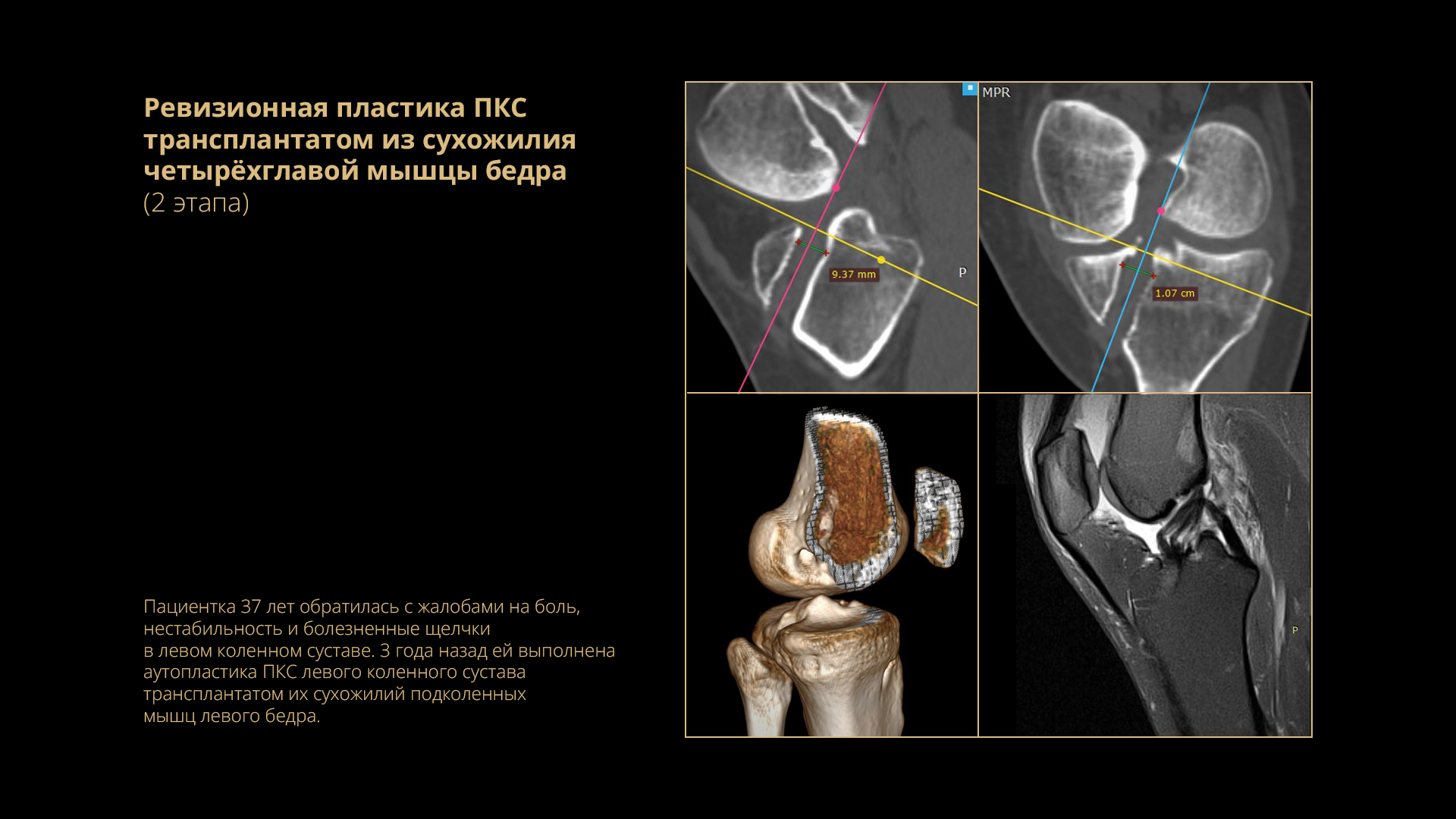 Ревизионная пластика ПКС трансплантатом из сухожилия четырёхглавой мышцы бедра (2 этапа)
