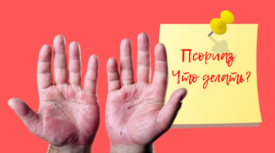 Псориаз | Что делать?