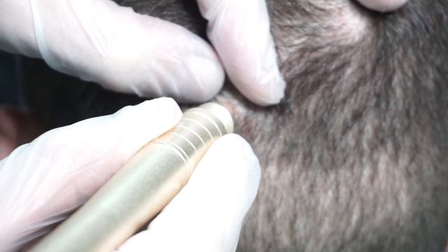 Как Удалить Родинку и Ангиому Диодным Лазером