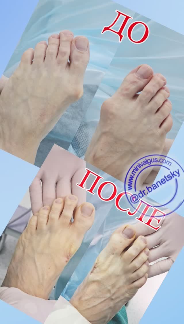 до и после операции на стопах