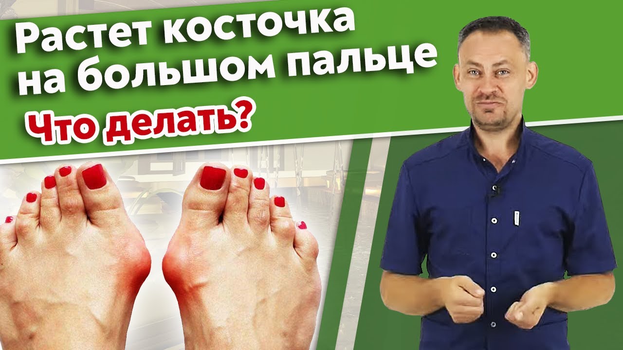 Hallux valgus / Почему торчат косточки на пальцах ног?