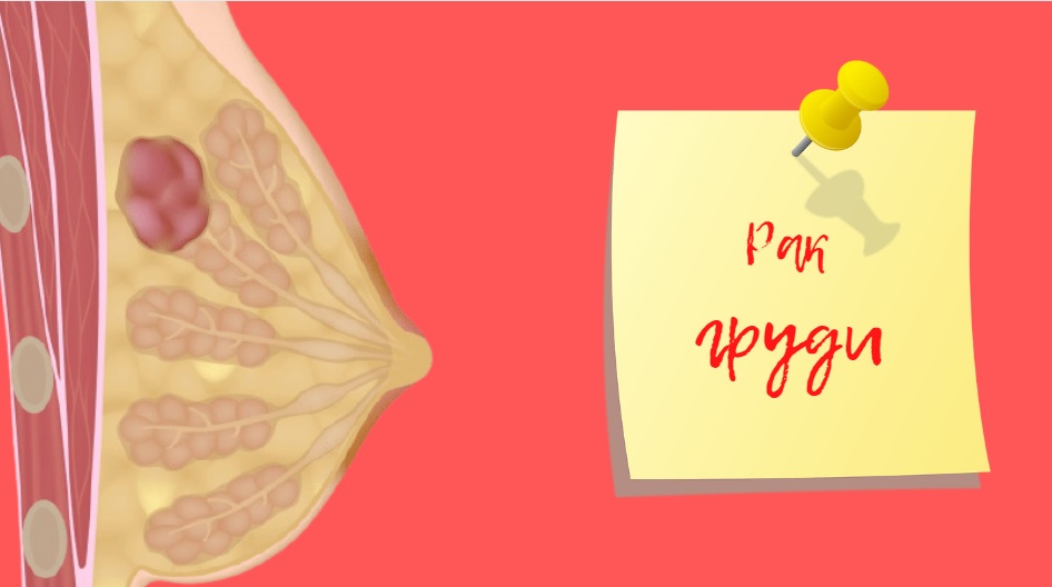 Рак груди | Как победить