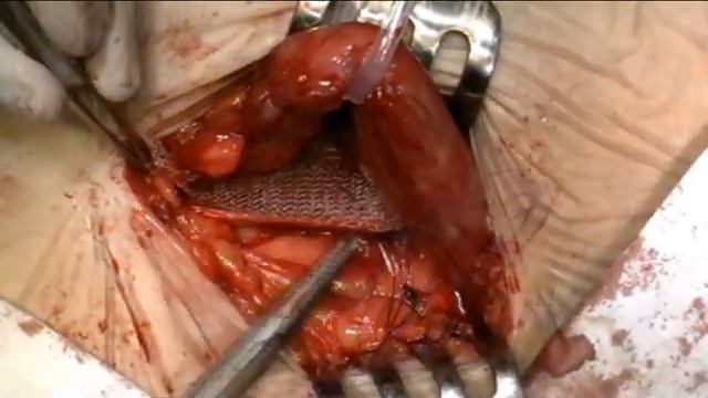 Паховое грыжесечение CS-пластика.mp4