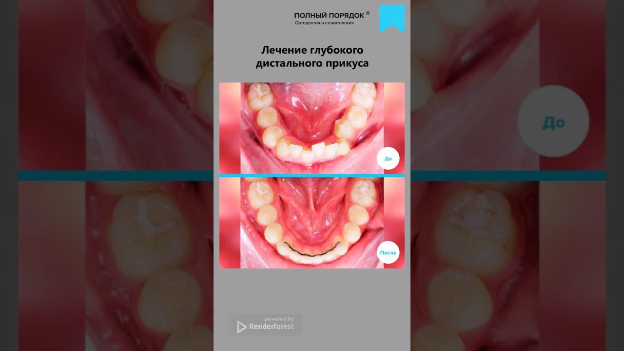 Результаты лечения глубокого дистального прикуса у подростка.