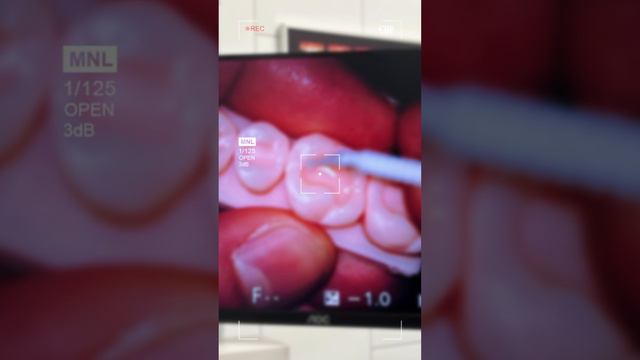 Реставрация зубов - смотрите процесс!