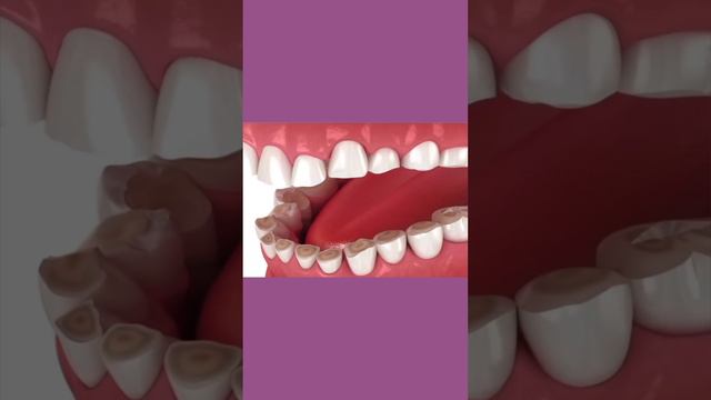 Стираемость зубов