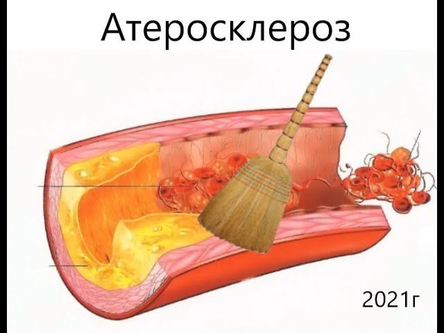 Атеросклероз (2021)