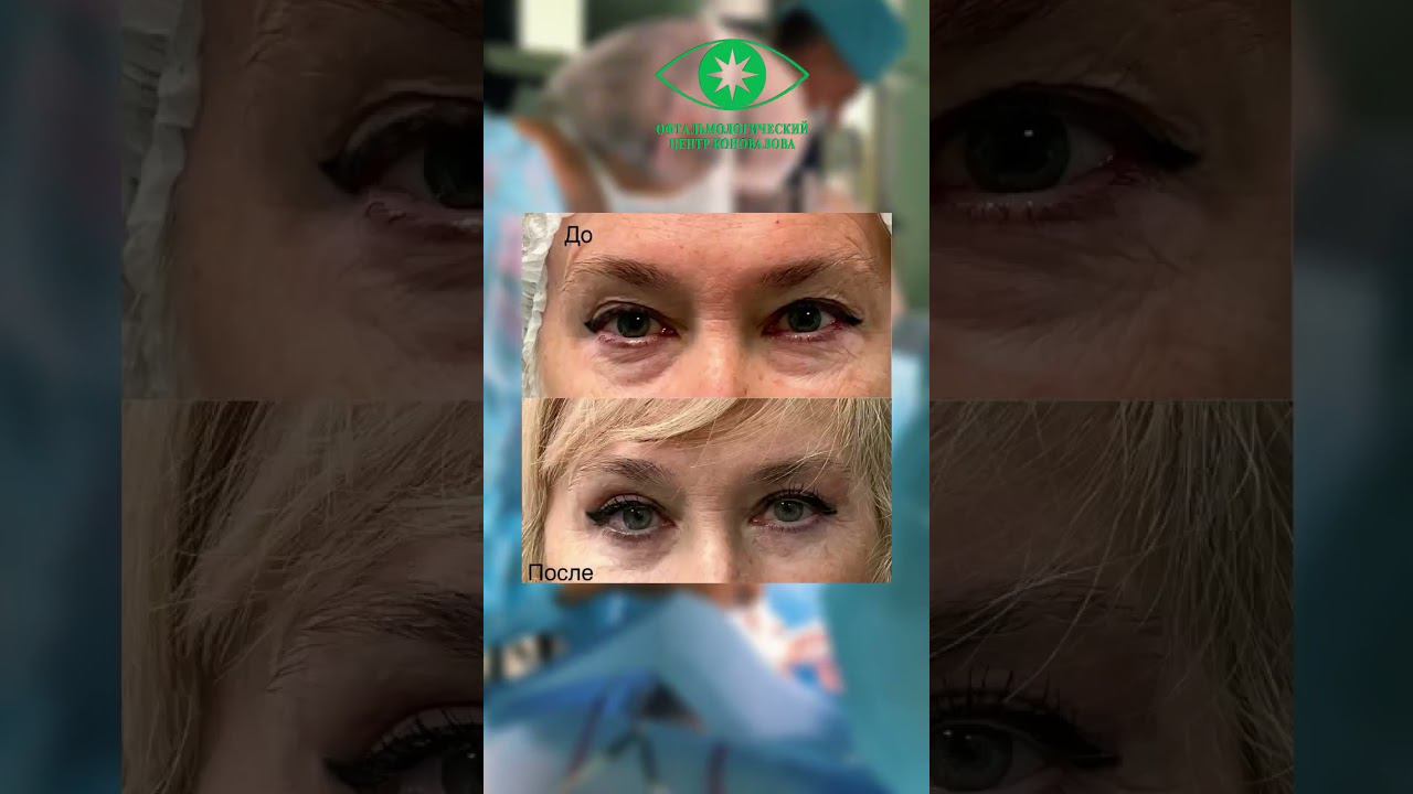 На что способна пластика век #пластикавек  #глазнаяклиника  #глазнаяклиникавмоскве