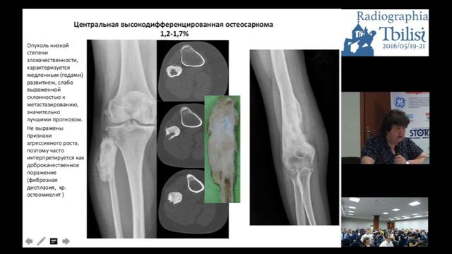 Остеосаркома редкие варианты. Лучевая диагностика