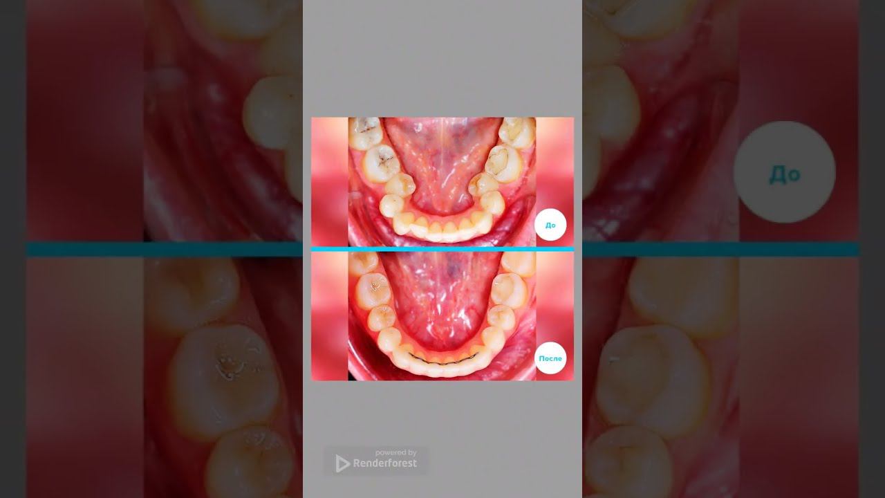 Результаты спустя 4 года после завершения ортодонтического лечения!