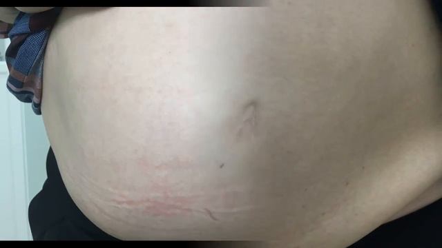 Удаление пупочной грыжи с установкой сетчатого эндопротеза в Уфе