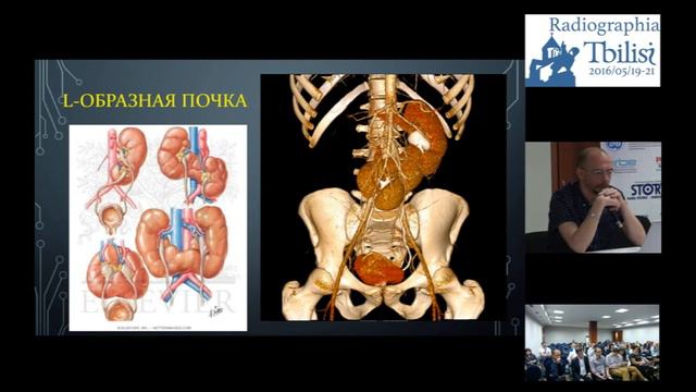 Аномалии развития МВС (СКТ)