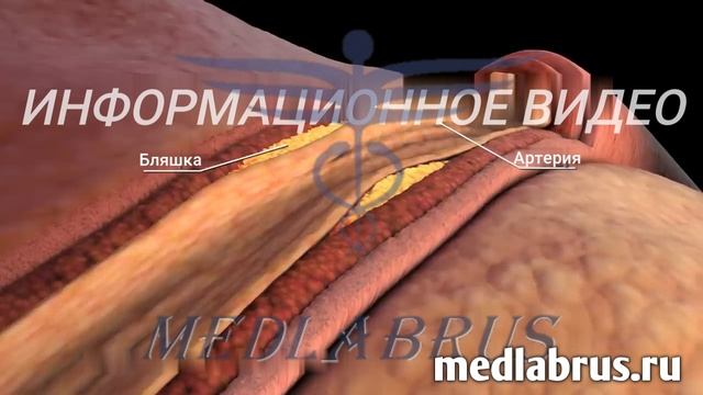 Холестерин - хороший и плохой!