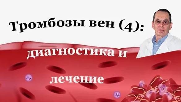 Тромбоз вен (4): Диагностика и лечение венозного тромбоза. Знания для ВСЕХ.