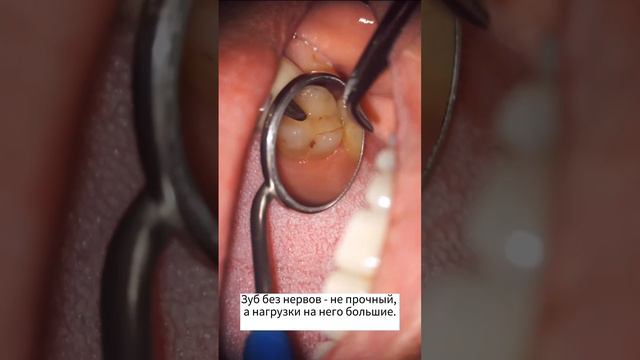 Зубы, которые разрушены, рассверлены-нужно протезировать.