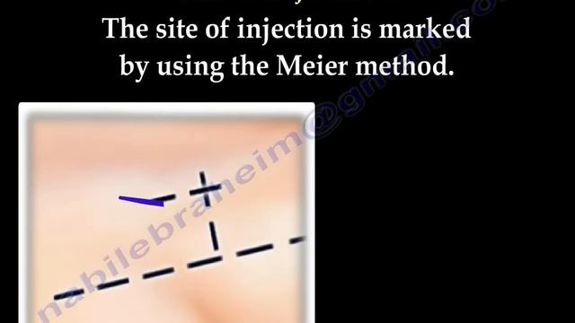 Блокада надлопаточного нерва - Everything You Need To Know - Dr. Nabil Ebraheim