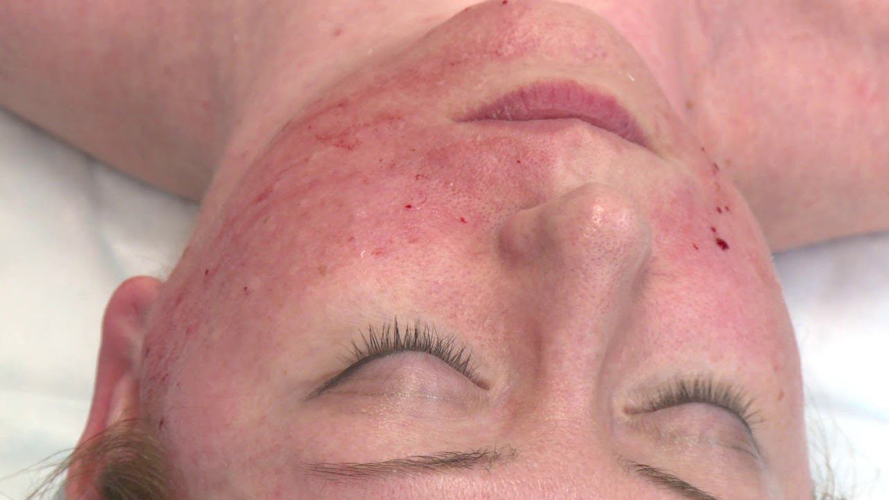 теория уколы