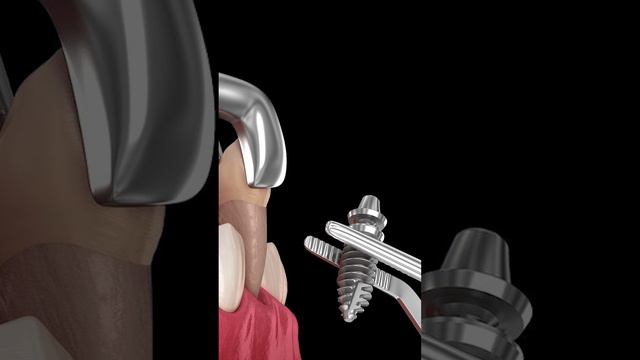 ОДНОМОМЕНТНАЯ ИМПЛАНТАЦИЯ