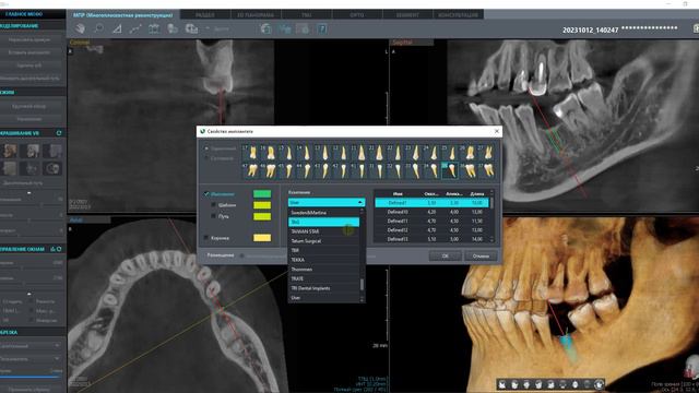 Установка виртуального имплантата по линейке