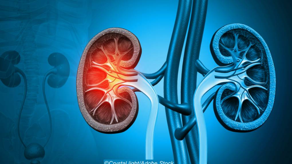 Хронический пиелонефрит