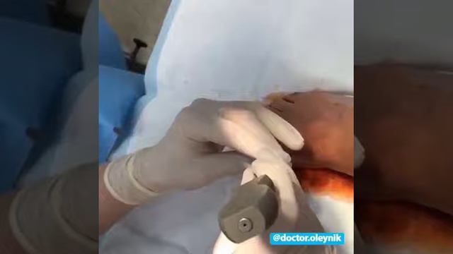 Как происходит удаление винтов из стопы | Доктор Алексей Олейник