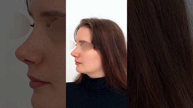 Ринопластика спустя 2 месяца
