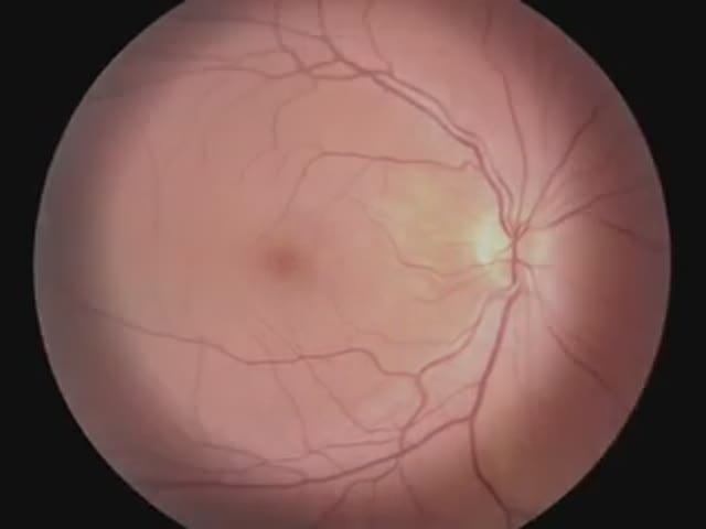 Непрямая офтальмоскопия - часть 1