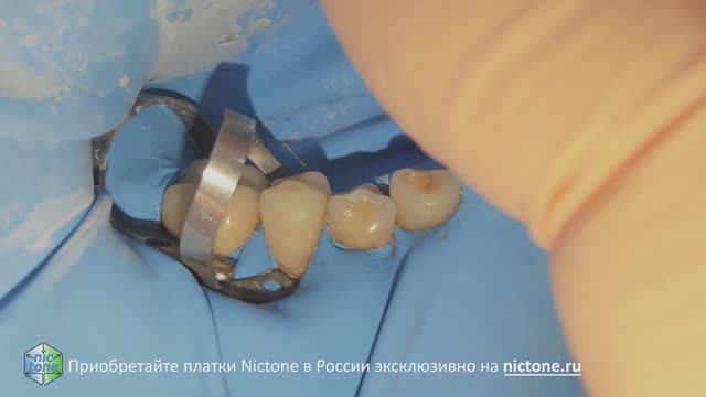 Киинические примеры применения Nictone