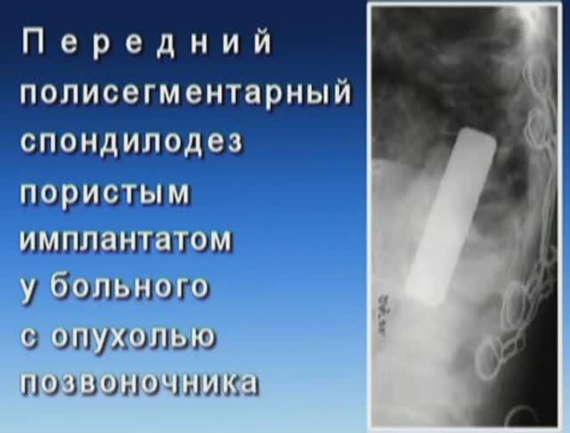 Две операции при опухолях позвоночника