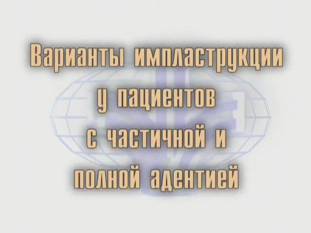 Варианты импластрукции при частичной и полной адентии
