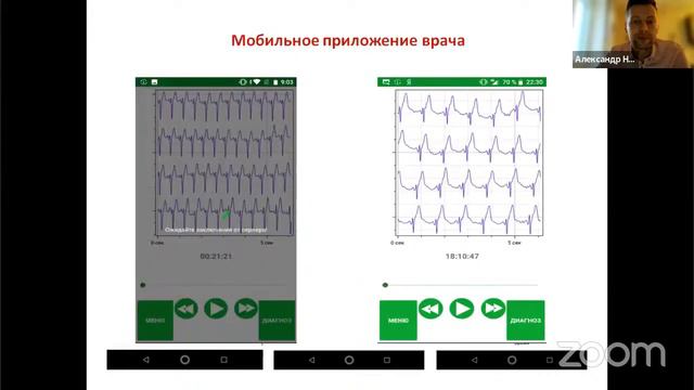 Новые возможности носимых устройств для регистрации ЭКГ в аритмологии