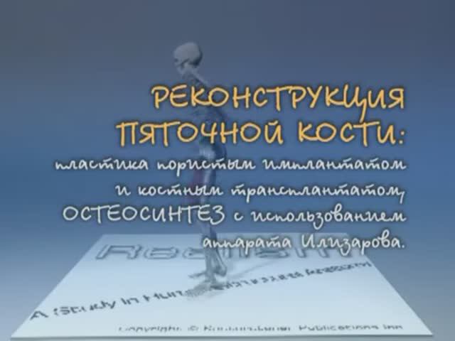 РЕКОНСТРУКЦИЯ ПЯТОЧНОЙ КОСТИ: пластика пористым имплантатом и костным трансплантатом