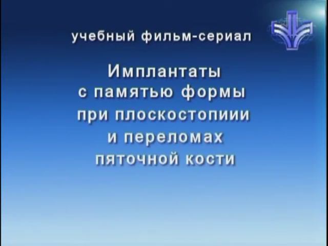 Имплантаты с памятью формы при плоскостопии и переломах пяточной кости