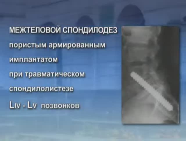 Хирургическое лечение спондилолистезов