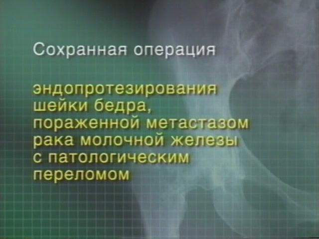 Сохранная операция эндопротезирования шейки бедра, пораженной метастазом рака молочной железы.