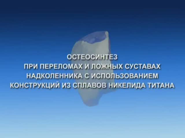 Остеосинтез надколенника и пористые имплантаты в хир-ом лечении переломов мыщелков большеб-вой кости